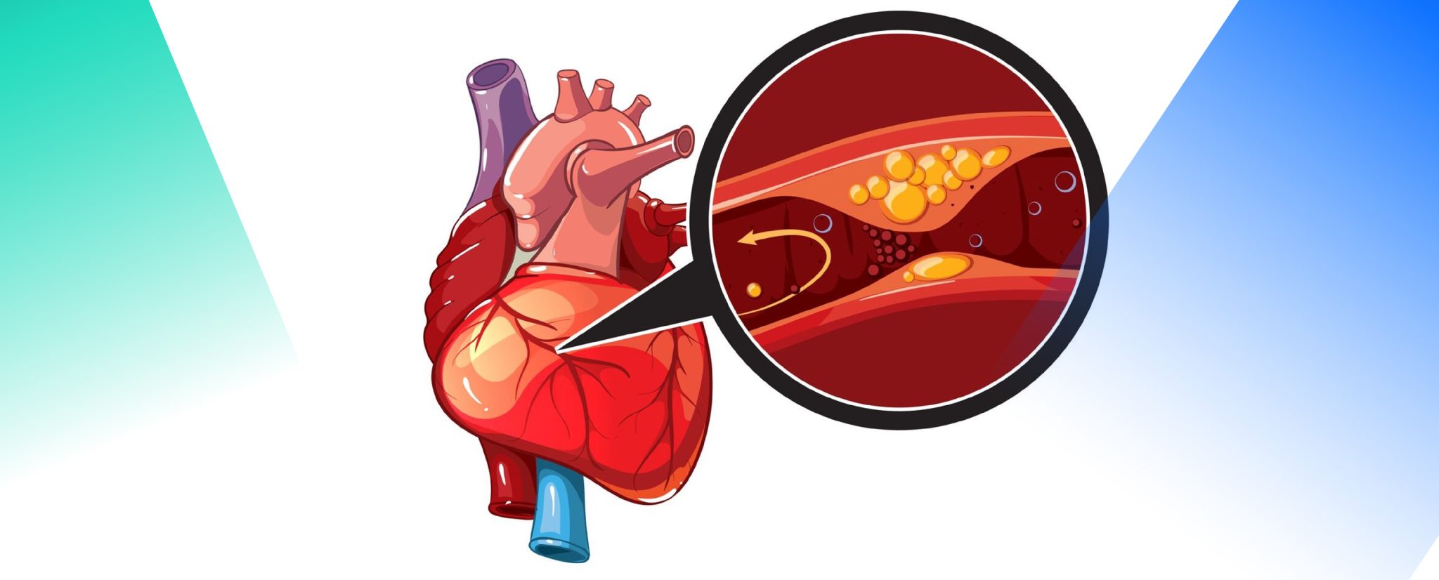 Advancing Cardiovascular Treatment with LS-DYNA Stent Simulation ...